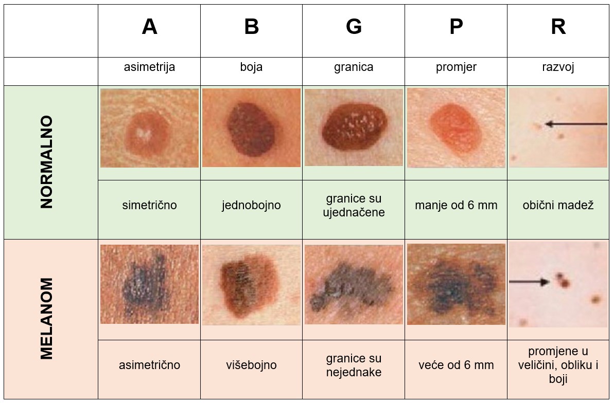 Rak kože – Županijska liga protiv raka Čakovec